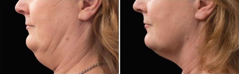 Eliminate Turkey Neck: Proven Tips & Treatments
