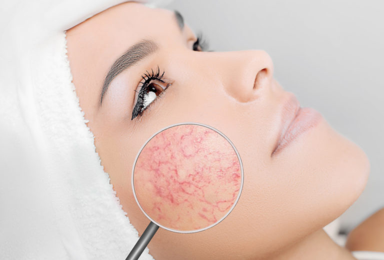 How To Identify And Cope With Your Rosacea Triggers