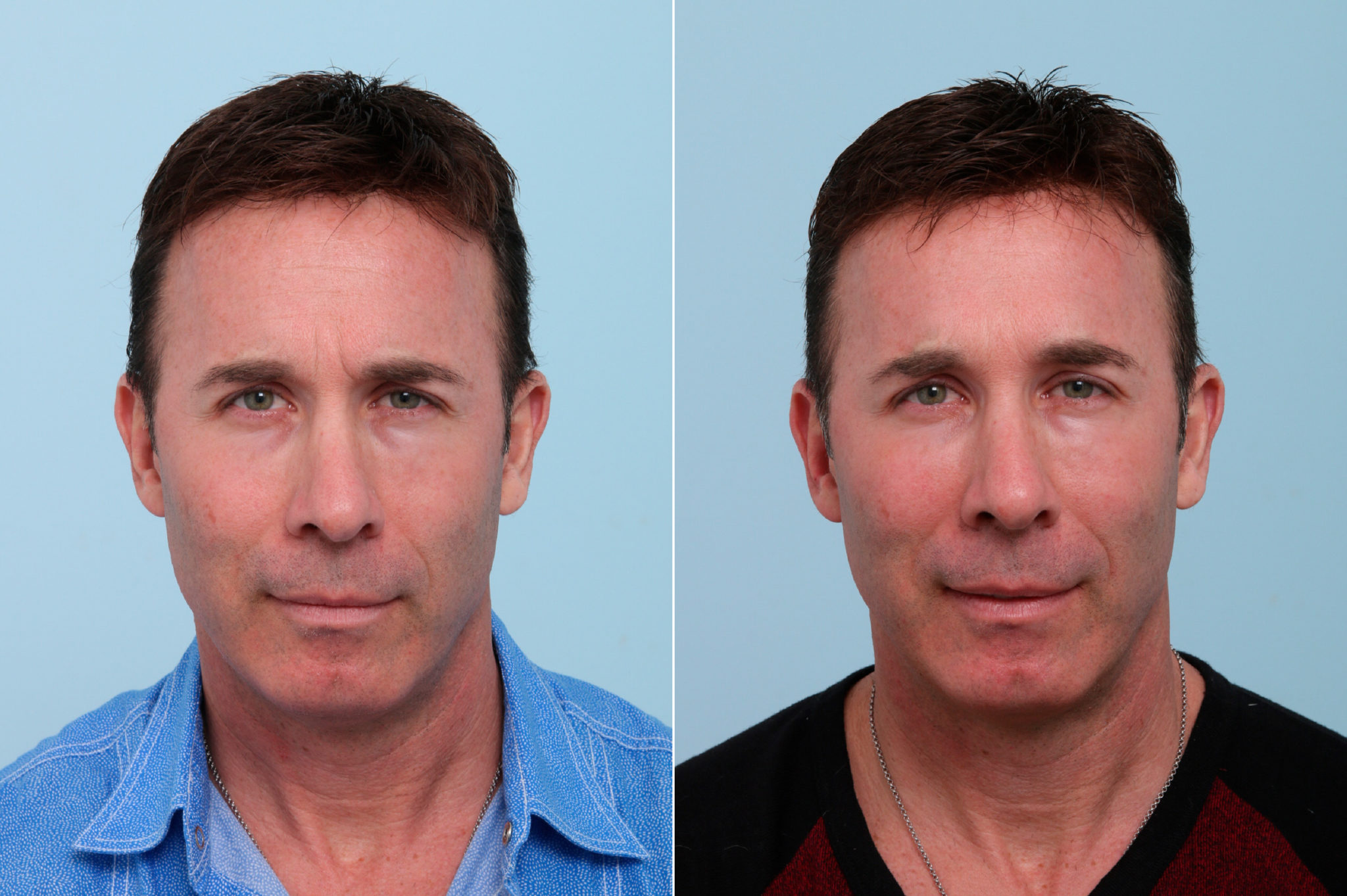 Discover Why Men Get Botox Look Younger And Feel Confident