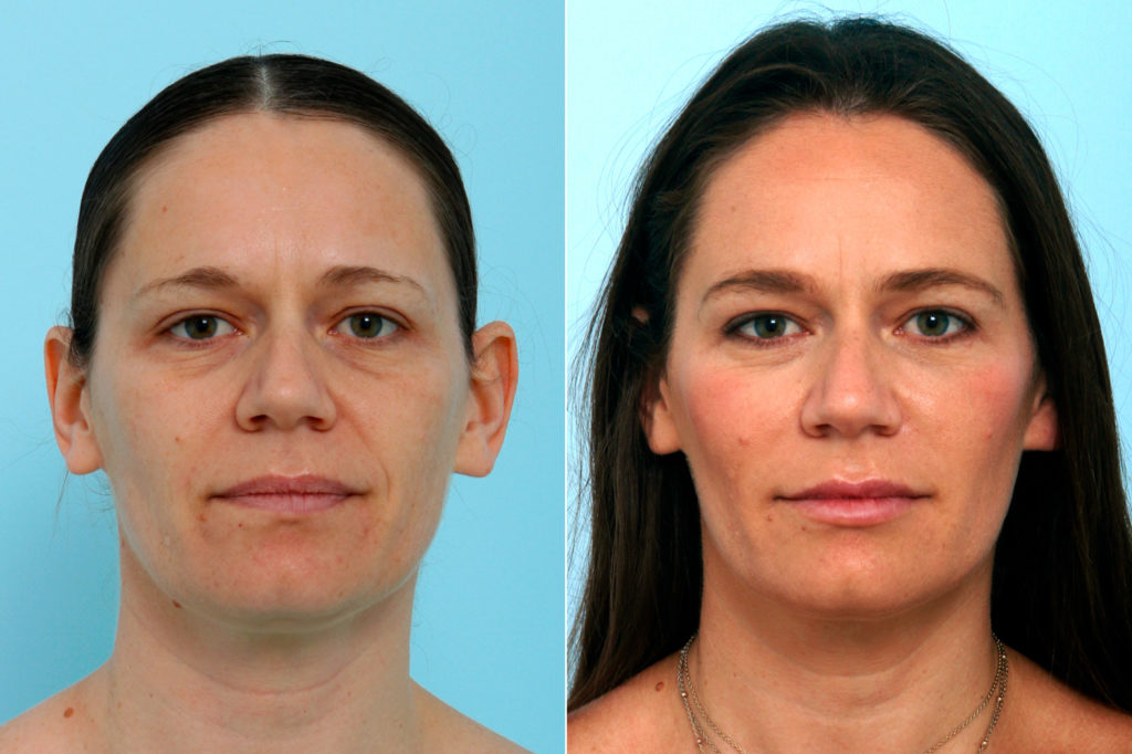 Five Techniques of Injecting Dermal Fillers | Houston, TX