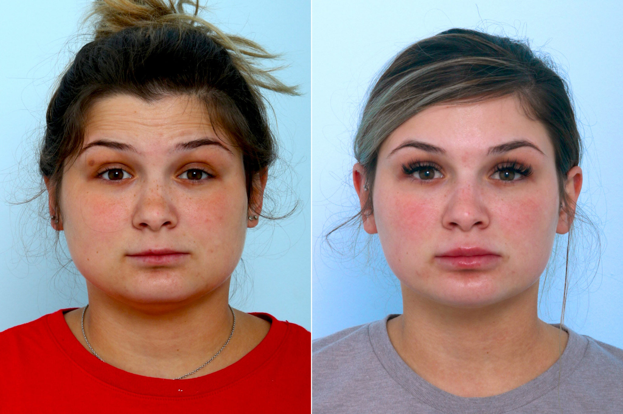 Avoid Bad Botox: Spot Safe Treatments Easily