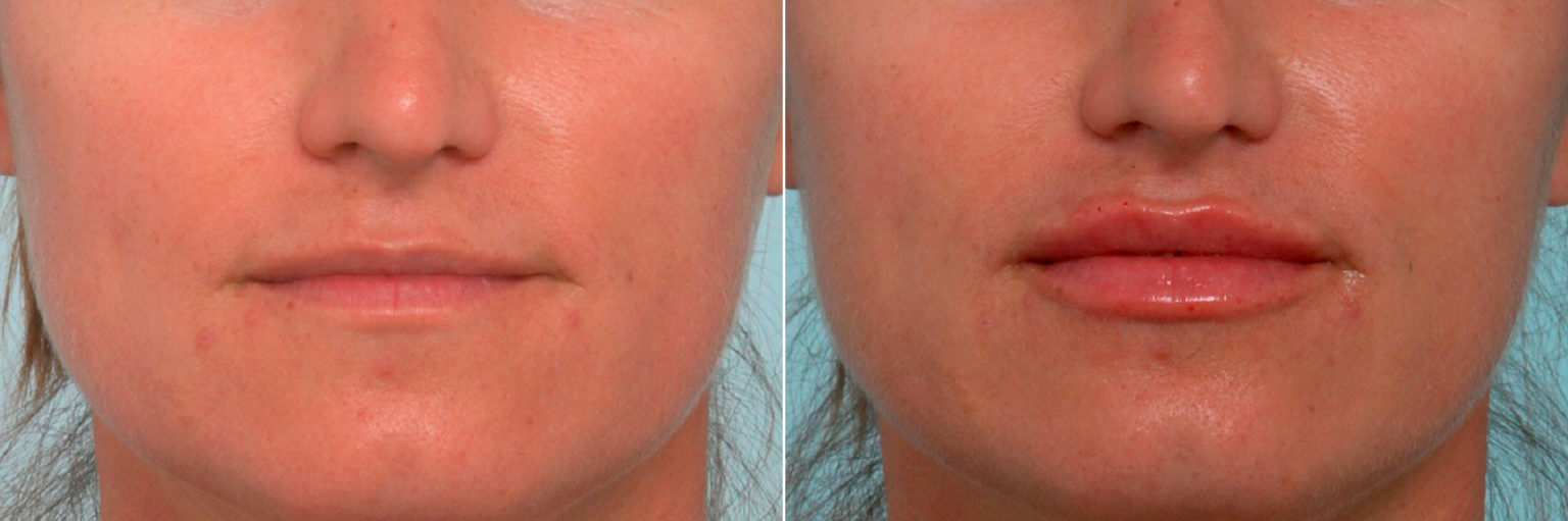 What Is The Russian Lip Technique? | Houston, TX