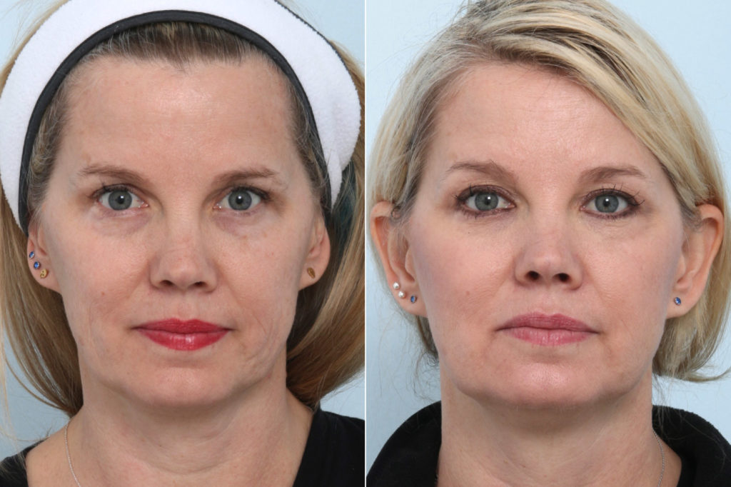 Thermage vs. Ultherapy: What is the Difference?