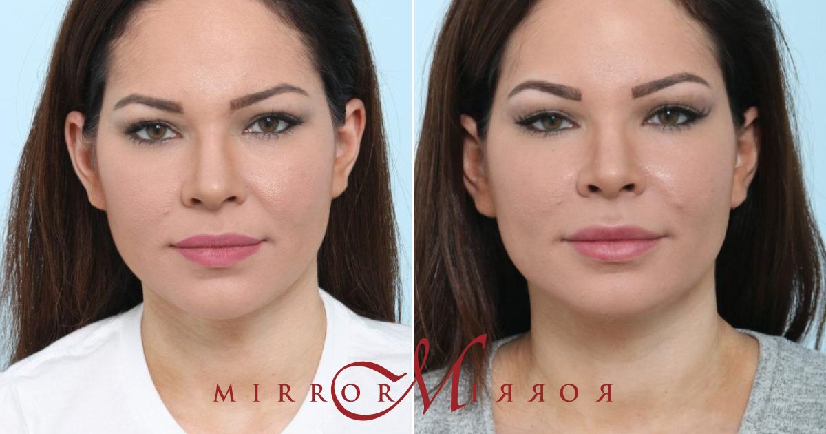 Juvederm Voluma XC | Cheek Filler in Houston, Texas