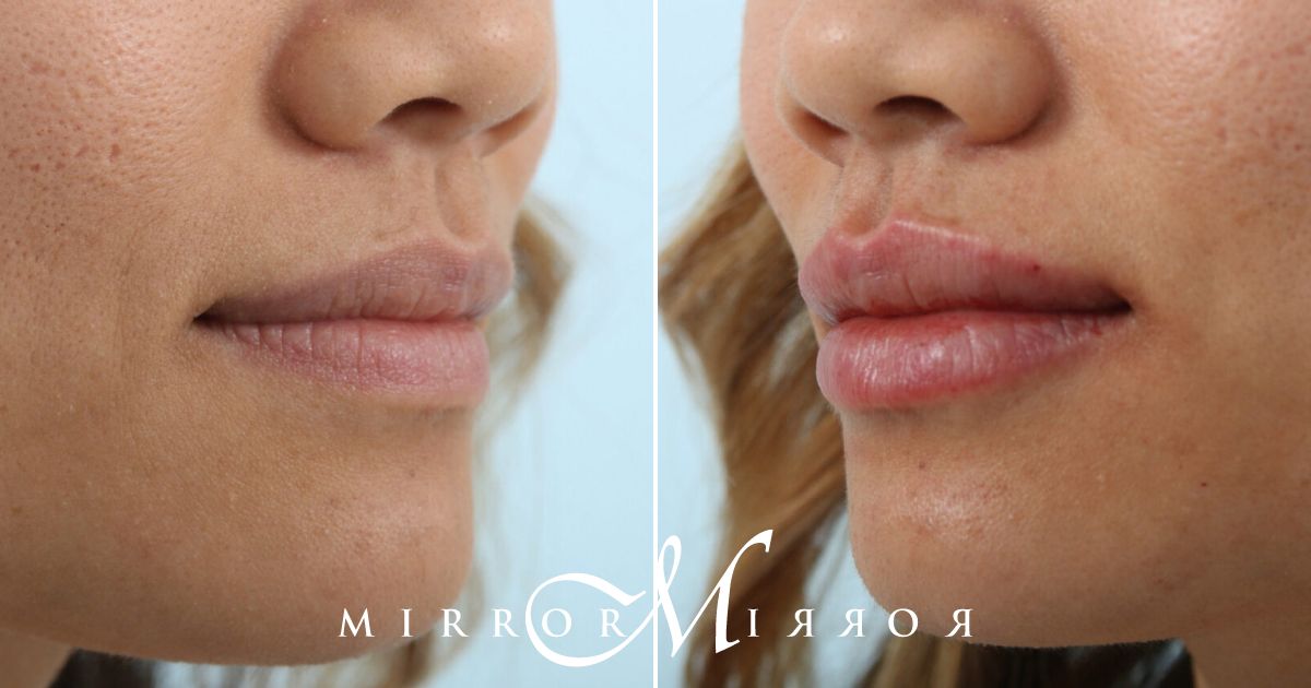 Lip Augmentation Houston TX - Lip Fillers River Oaks TX